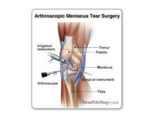 Arthroscopic Meniscus Tear Surgery - St. George Surgical Center